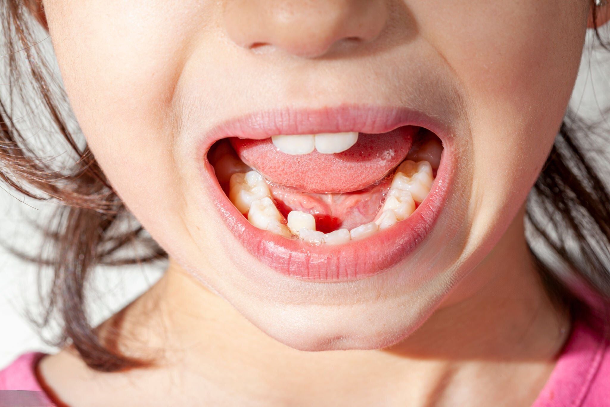 Minor vs. Major Teeth Misalignments: Effective Treatment | Smileie AU ...