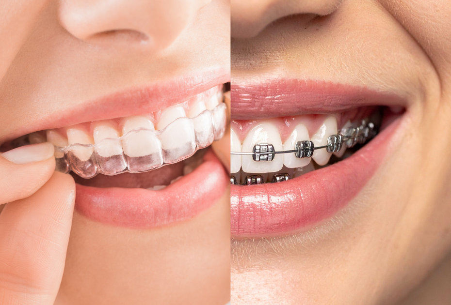 Clear aligners vs braces Europe: 2026 comparison – Smileie Australia